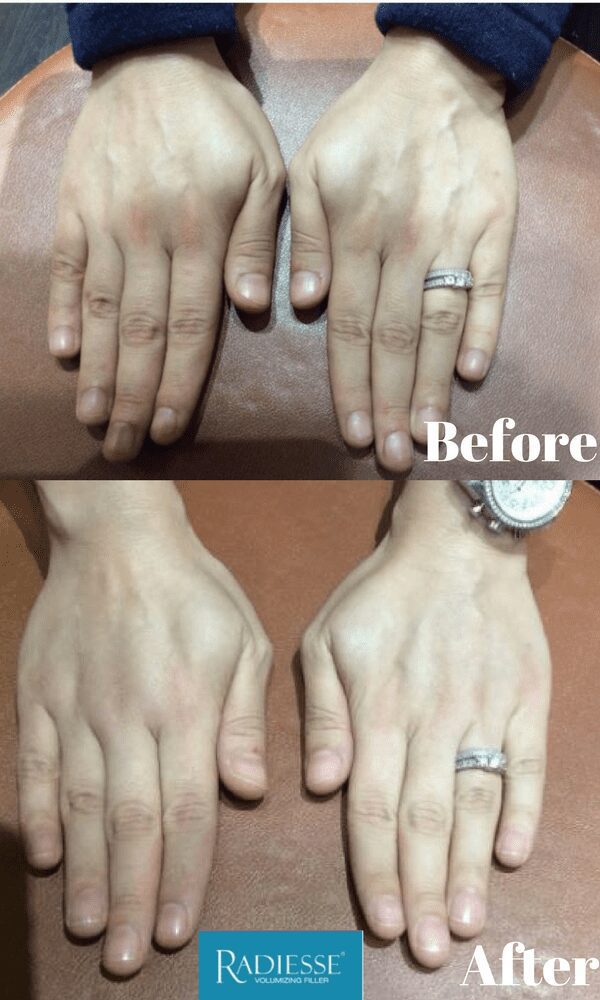 Radiesse For Hands Sugar Land - Hand Fillers Greatwood TX